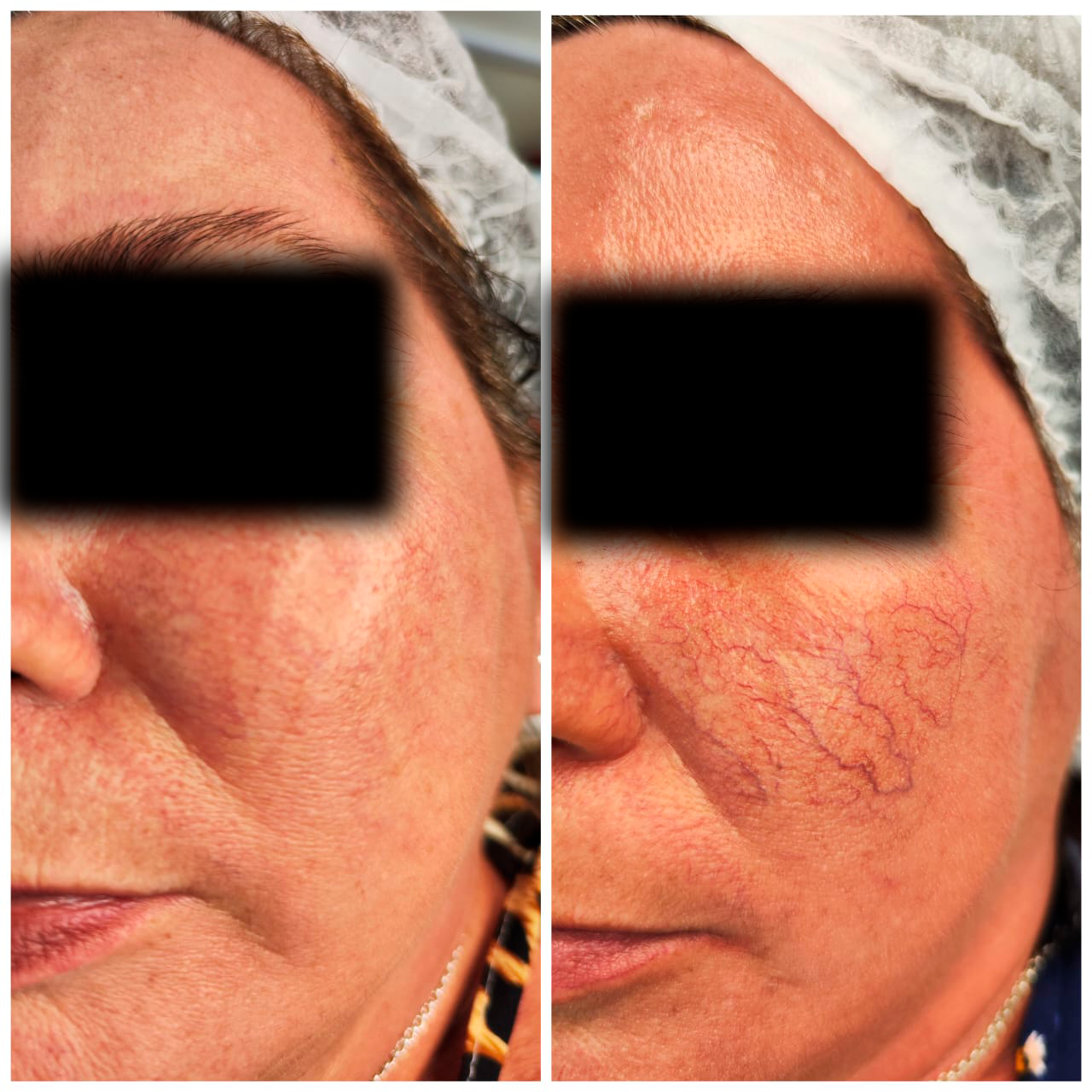 Tratamento de Microvarizes a Laser - CBLASER